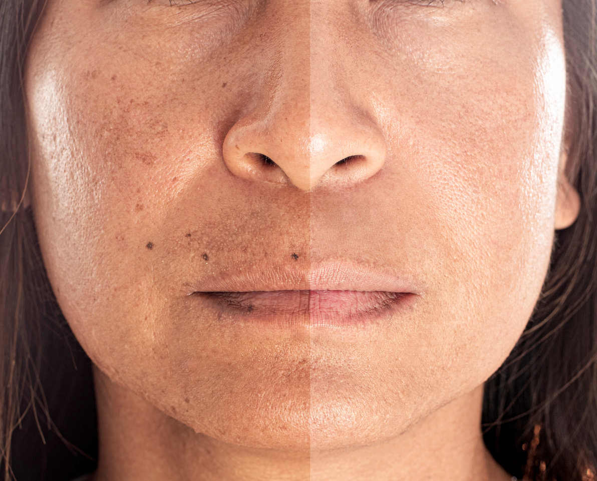 All You Need to Know About Chemical Peels - A&E Magazine